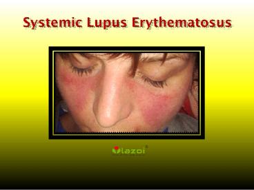 PPT – Systemic Lupus Erythematosus: Causes, Symptoms, Daignosis ...