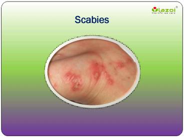 Scabies: Causes, Symptoms, Daignosis, Prevention and Treatment ...
