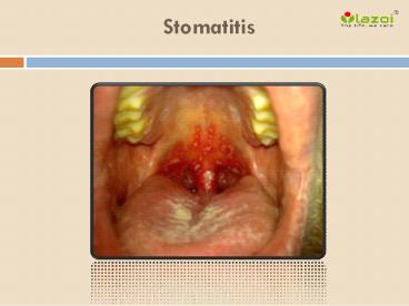 Stomatitis: Causes, Symptoms, Daignosis, Prevention and Treatment ...