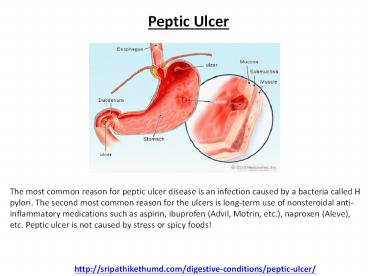 PPT – peptic-ulcer PowerPoint presentation | free to download - id: 8dad80-Y2EyO