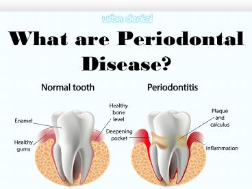 What are Periodontal Disease? presentation | free to download