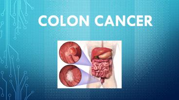 PPT – Colon Cancer || Indore PowerPoint presentation | free to download ...