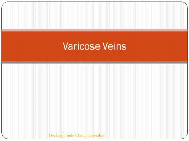 PPT – Varicose Vein PowerPoint presentation | free to download - id: 913394-MDFhZ