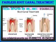 PPT – Root Canal Treatment in Tricity PowerPoint presentation | free to ...