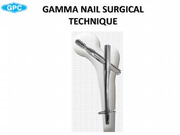 GAMMA NAIL SURGICAL TECHNIQUE presentation | free to download