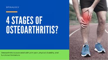 4 Stages of Osteoarthritis presentation | free to download