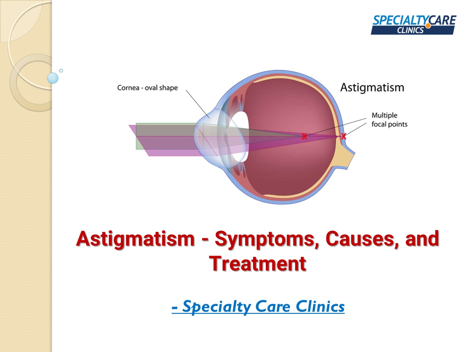 Astigmatism - Symptoms, Causes, and Treatment presentation | free to ...