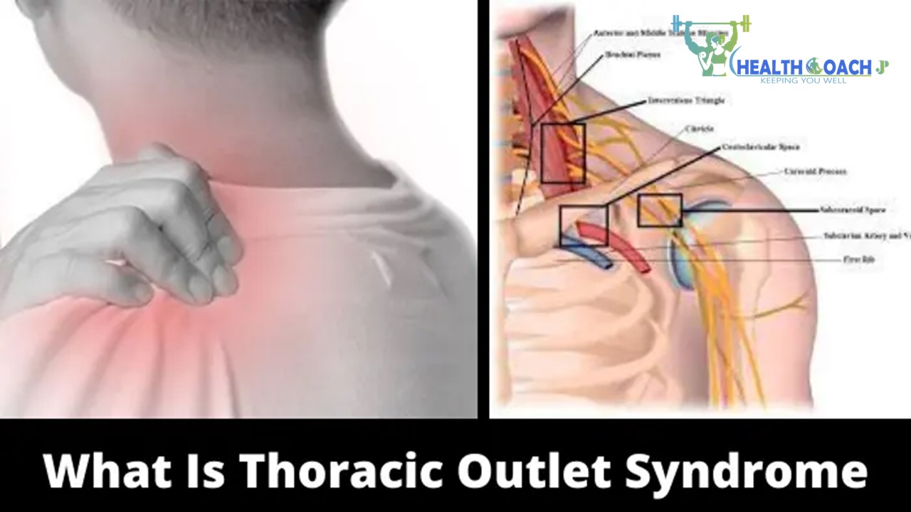 PPT – Stretching Exercises For Thoracic Outlet Syndrome Treatment ...