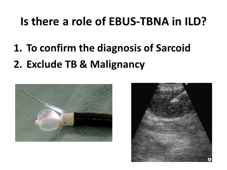 PPT – Is there a role of EBUS-TBNA in ILD Part 7 Dr. Sheetu singh ...