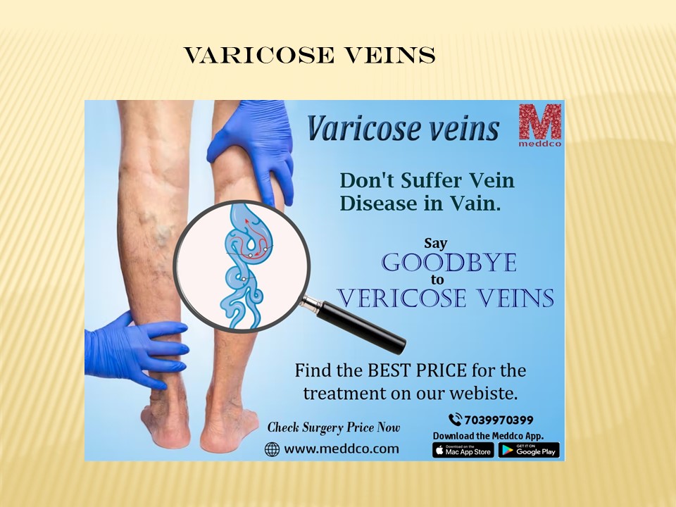 Varicose Veins presentation | free to download