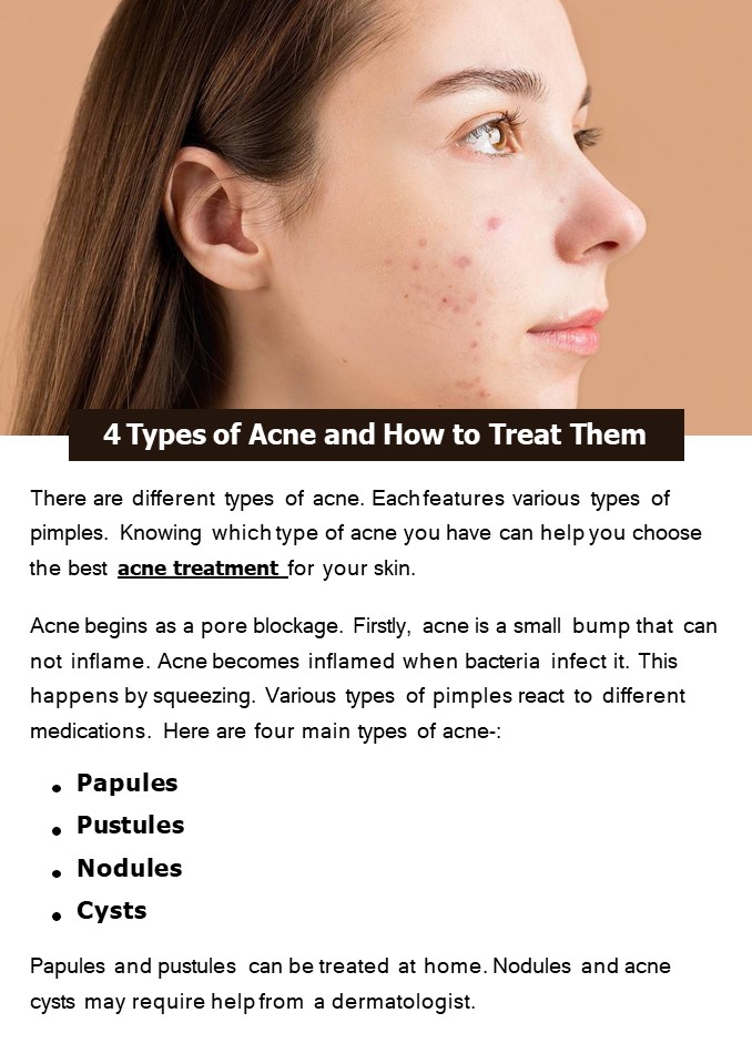 PPT – 4 Types of Acne and How to Treat Them PowerPoint presentation ...