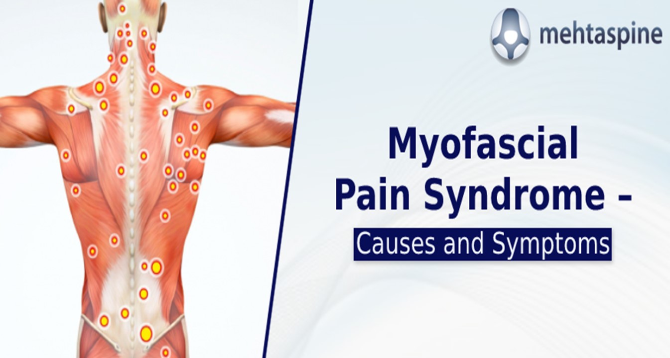 PPT – Myofascial Pain Syndrome – Causes and Symptoms| Mehta Spine PowerPoint presentation | free ...