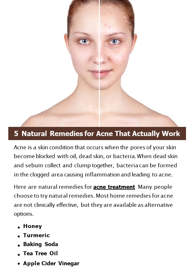 PPT – 5 Natural Remedies for Acne That Actually Work PowerPoint ...