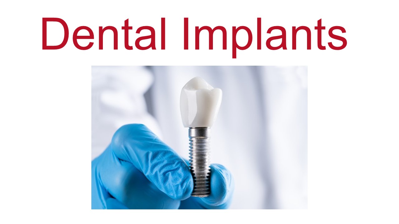 What are Dental Implants? presentation | free to download
