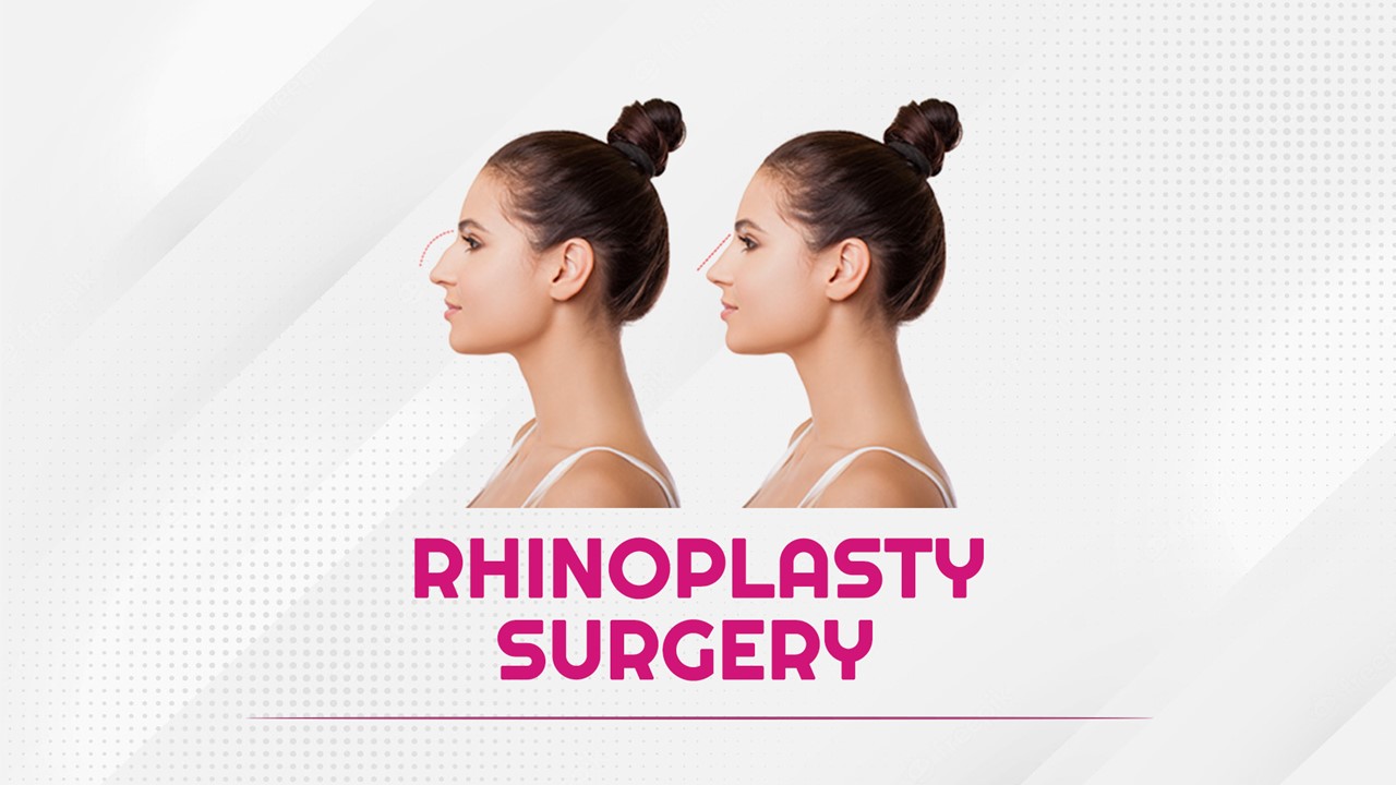 Benefits of Rhinoplasty Surgery presentation | free to download