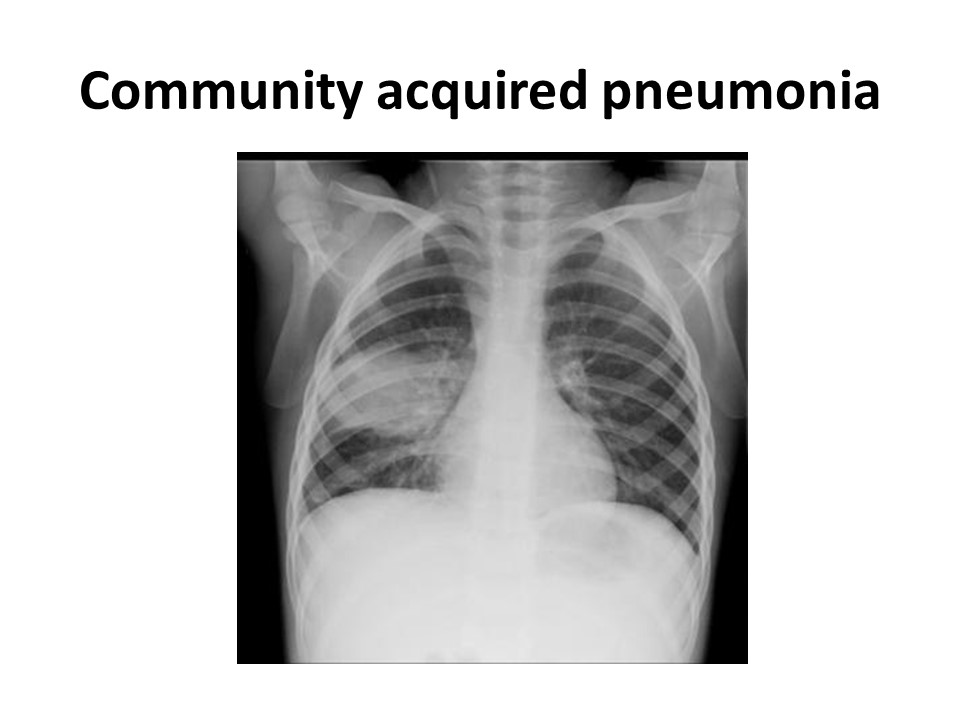 PPT – Community acquired pneumonia and Bronchiolitis reports by Dr ...