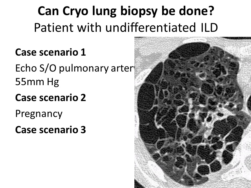 Can Cryo lung biopsy be done Patient with undifferentiated ILD - Dr ...