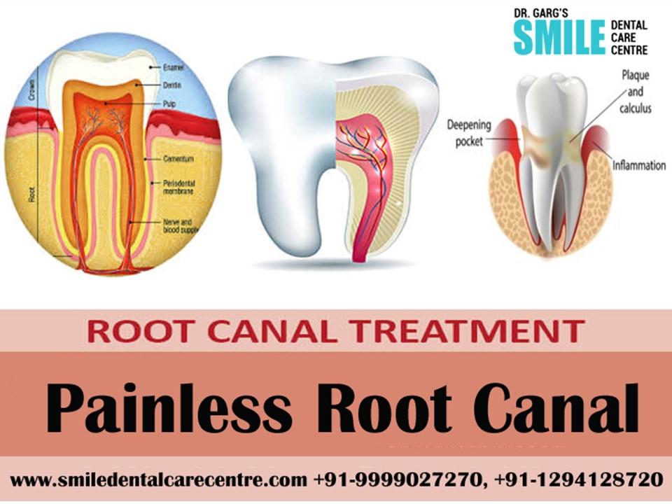 PPT – Can Painless Root Canal Treatment procedure be performed in India ...