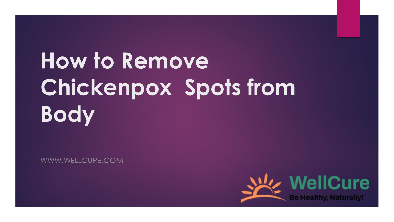 PPT – How to Remove Chickenpox Spots from Body - Wellcure PowerPoint ...