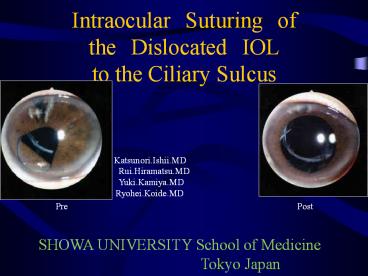 PPT – Intraocular Suturing of the Dislocated IOL to the Ciliary Sulcus ...