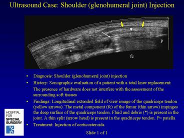PPT – Ultrasound Case: Shoulder glenohumeral joint Injection PowerPoint ...