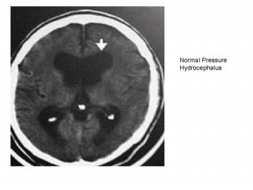 Normal Pressure Hydrocephalus presentation | free to view