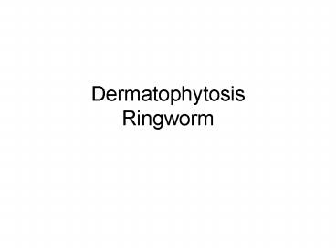 Dermatophytosis Ringworm presentation | free to view