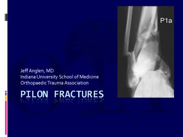 PIlon Fractures presentation | free to view