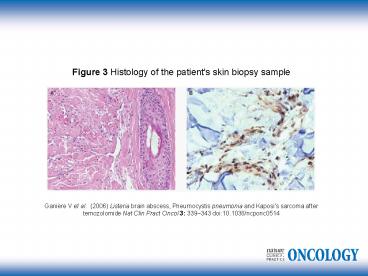 Ganire V et al' 2006 Listeria brain abscess, Pneumocystis pneumonia and ...