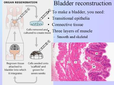 Bladder reconstruction presentation | free to view