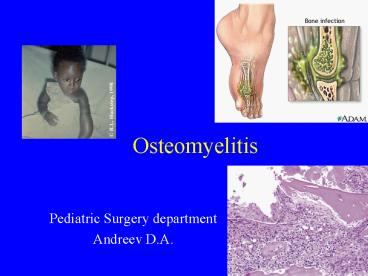 Osteomyelitis presentation | free to view