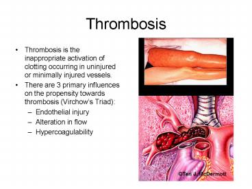 Thrombosis presentation | free to view