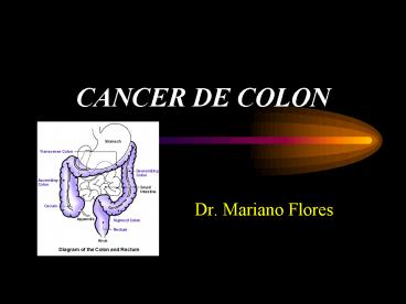 CANCER DE COLON presentation | free to view
