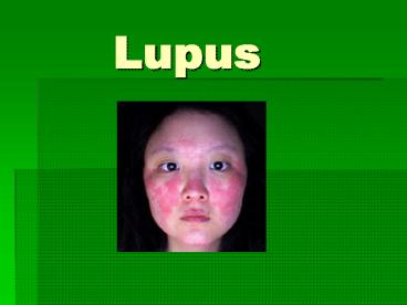 Lupus presentation | free to view
