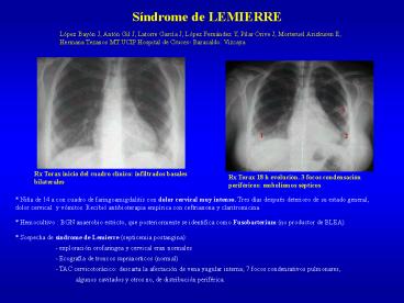 Sndrome de LEMIERRE presentation | free to view