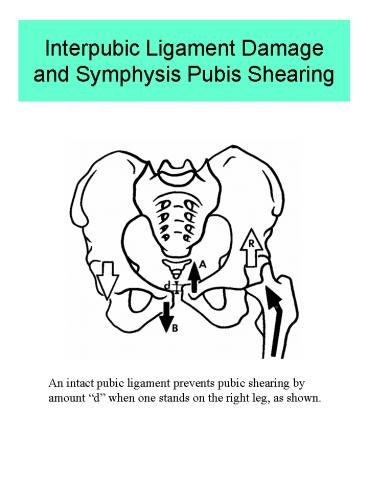 PPT – Interpubic Ligament Damage and Symphysis Pubis Shearing ...