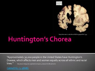 Huntingtons Chorea presentation | free to view