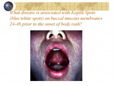 PPT – What disease is associated with Koplik Spots bluewhite spots on ...