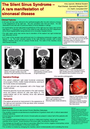 The Silent Sinus Syndrome A rare manifestation of sinonasal disease ...
