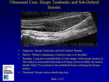 Ultrasound Case: Biceps Tendonitis and SubDeltoid Bursitis presentation ...