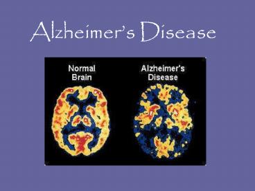Alzheimers Disease presentation | free to view