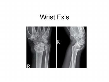 Wrist Fxs presentation | free to view