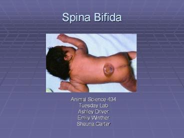 Spina Bifida presentation | free to download