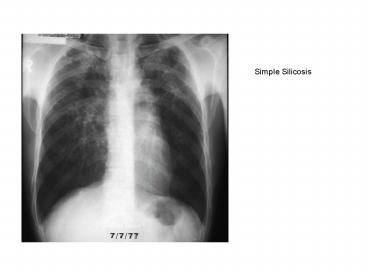 PPT – Simple Silicosis PowerPoint presentation | free to view - id ...