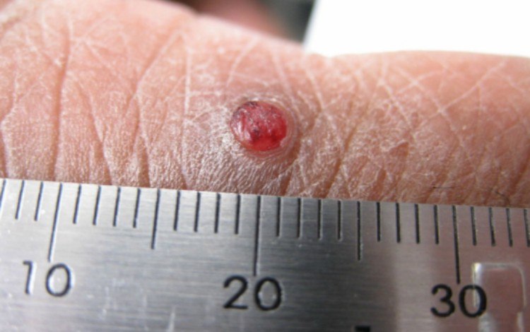 Here’s What Your New “Red Mole” Could Mean