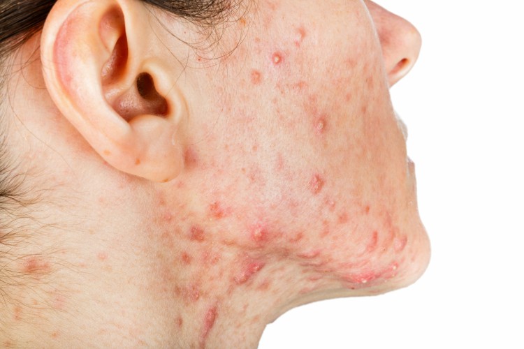 Skin Conditions That Are Commonly Mistaken For Acne