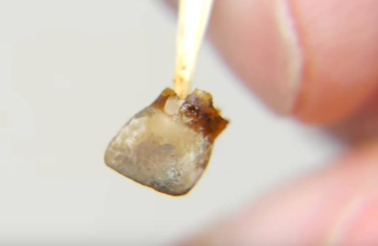 This is What a Tooth Looks Like After Soaking for a Month in Coke