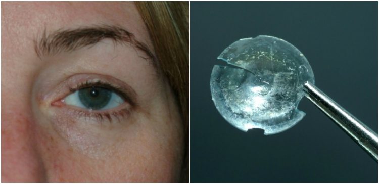A Woman Had A Contact Lens Stuck In Her Eye For 28 Years and Did Not ...