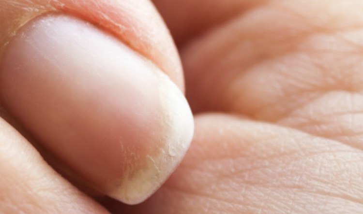 5 Health Issues You Can See on Your Fingernails