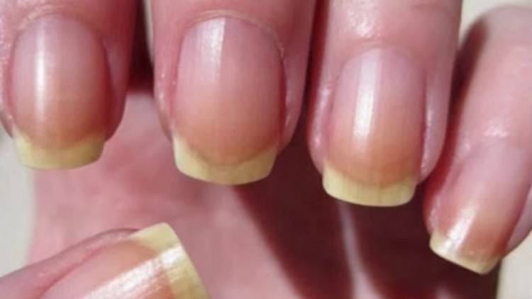 Here’s What it Means if Your Nails are Brittle, Spotted, Ridged or Broken
